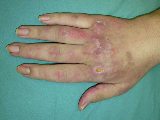 Viêm đa cơ và Viêm da cơ tự miễn