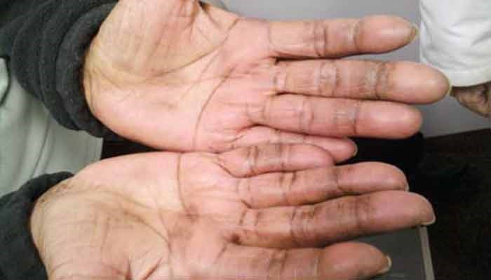 Viêm đa cơ và Viêm da cơ tự miễn