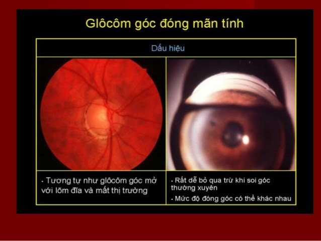 Glôcôm nguyên phát góc đóng
