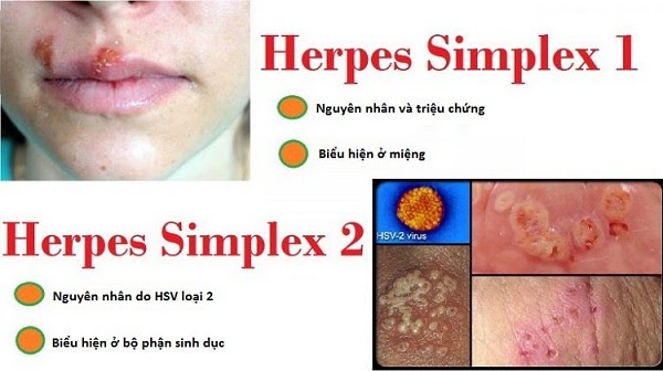 Herpes simplex vùng hậu môn sinh dục