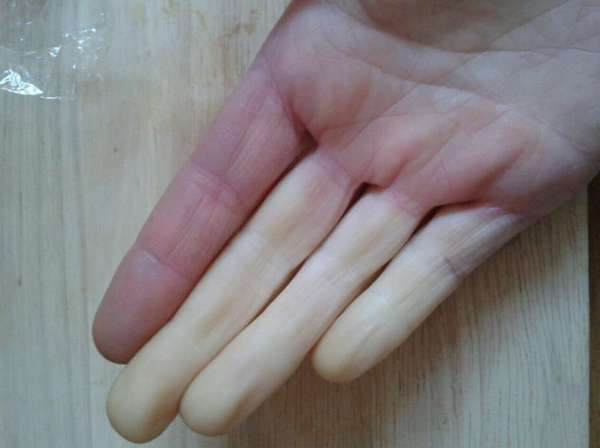 Hiện tượng Raynaud