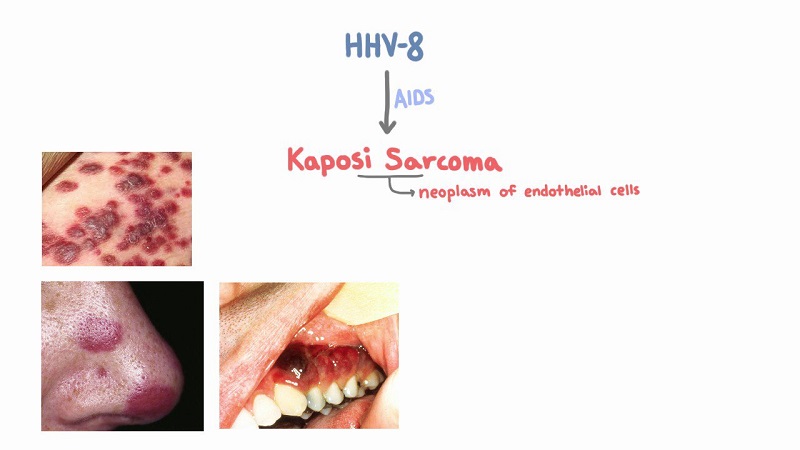 Kaposi sarcoma