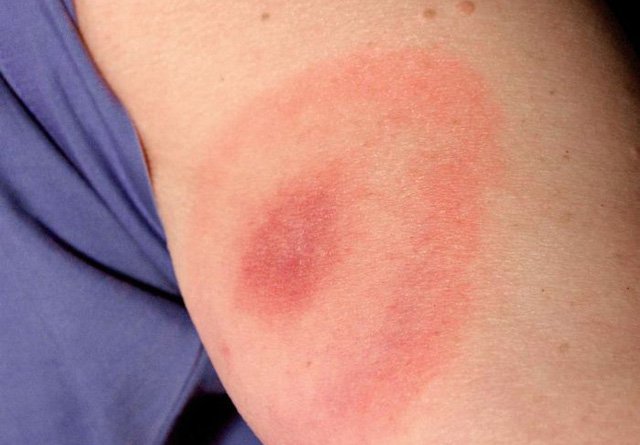 Bệnh Lyme