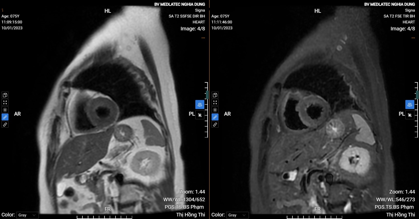 Chụp cộng hưởng từ (MRI) tim tại trung tâm chẩn đoán hình ảnh MEDIM ...