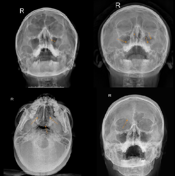 Giá trị của chụp X-quang trong chẩn đoán các bệnh lý về xoang