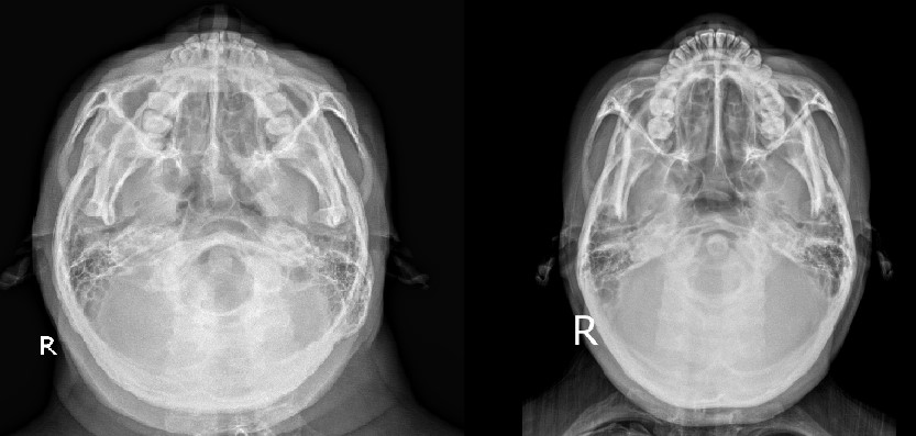 Giá trị của chụp X-quang trong chẩn đoán các bệnh lý về xoang