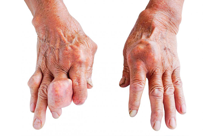 Những điều cần biết về nguyên nhân bệnh gout là gì tin cậy từ chuyên gia