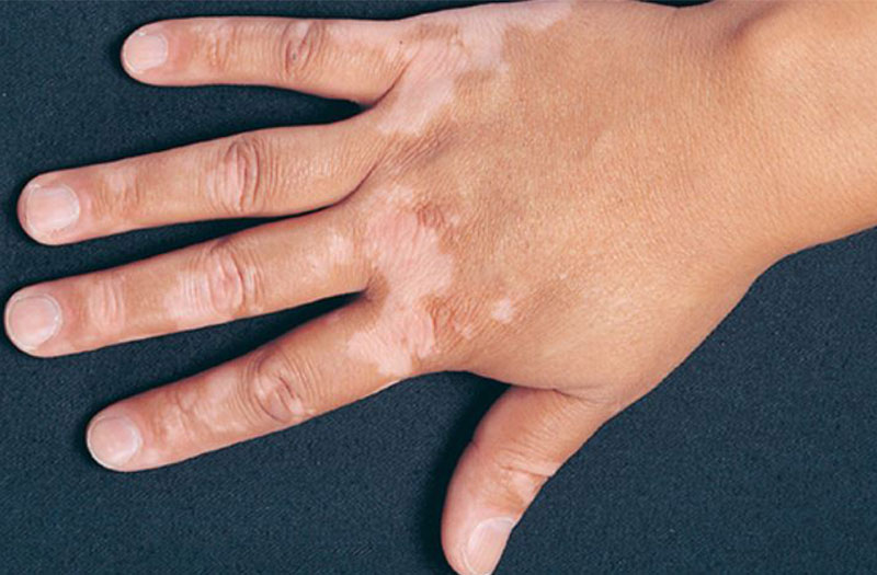 Điều trị và cách phòng chống bệnh lang beng hiệu quả tại nhà