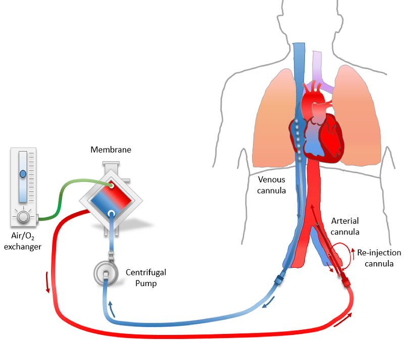 ECMO là gì và ý nghĩa của phương pháp này với người bệnh | Medlatec