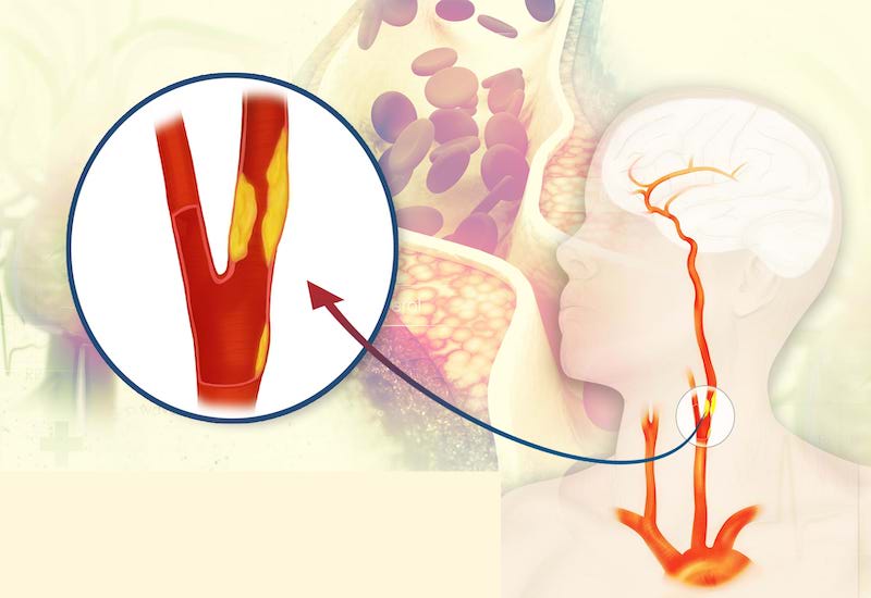 Định nghĩa xơ vữa đông mạch cảnh là gì và tác hại đối với cơ thể