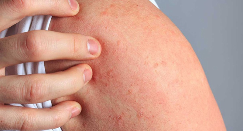 Dị ứng tôm: Cách nhận biết và xử lý | Medlatec